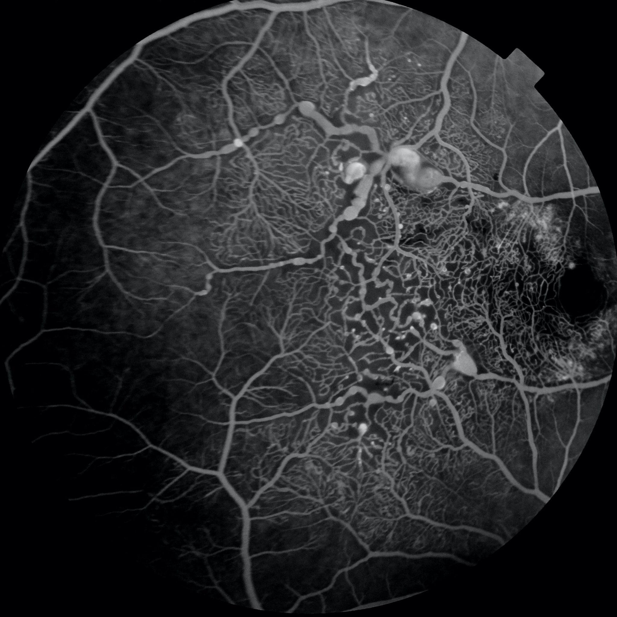 Gene Therapy For Inherited Retinal Diseases Dr Rehman Siddiqui