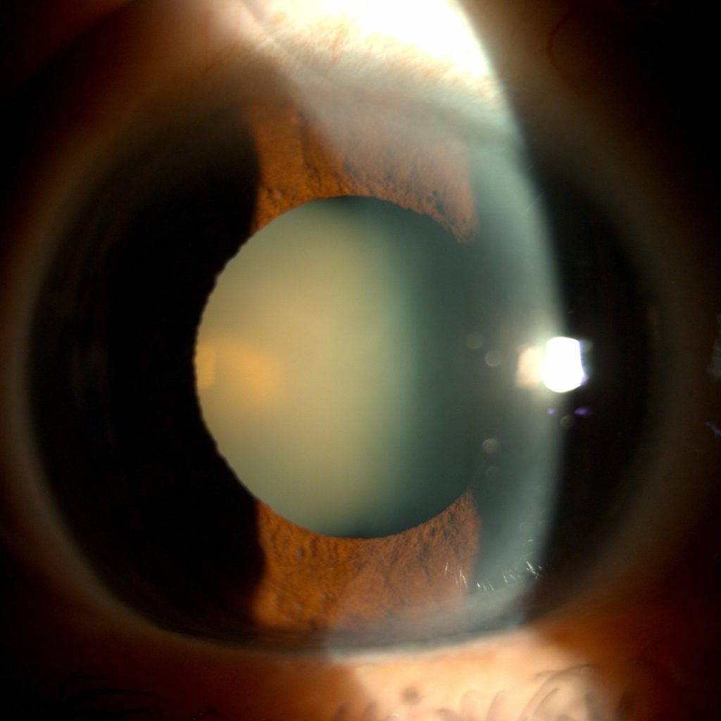 Cataract Phaco Surgery Lens (IOL) Options- CLAREON | VIVITY | PanOptix ...