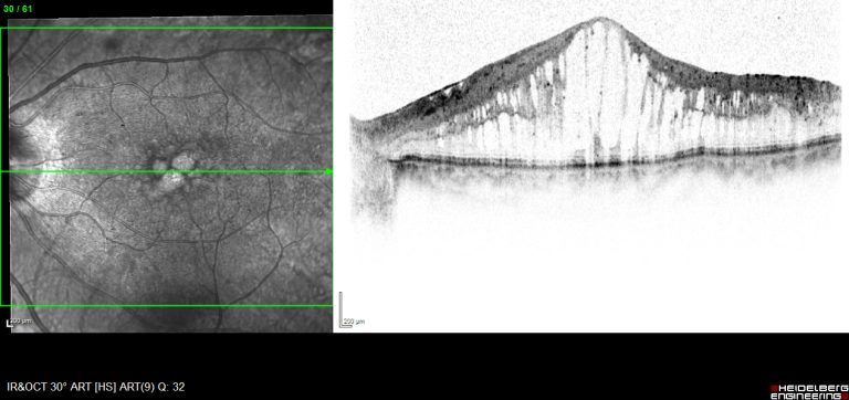 Diabetic Macular Edema- Risk Factors and Treatment Options - Dr Rehman ...