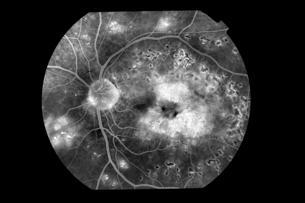 Diabetic Macular Edema- Risk Factors and Treatment Options - Dr Rehman ...