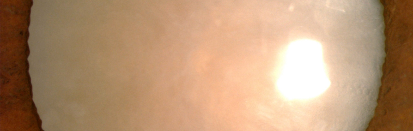 Cataract Phaco Surgery Overview - Dr Rehman Siddiqui