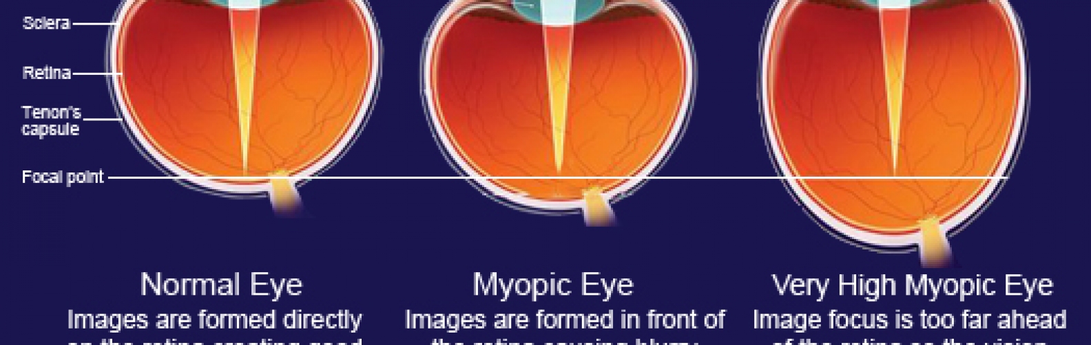 High Myopia (short-sightedness) - Dr Rehman Siddiqui