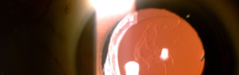 Posterior Capsular Opacification (PCO) - Dr Rehman Siddiqui