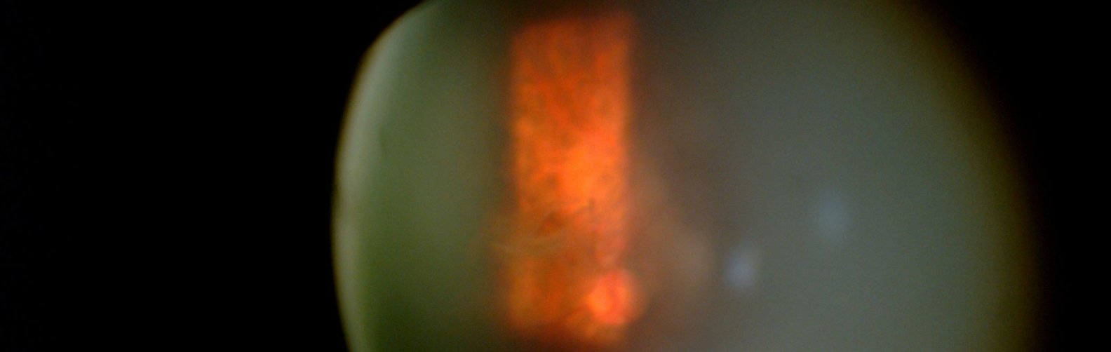 Posterior Vitreous Detachment - Dr Rehman Siddiqui